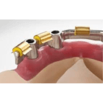 VX Hader Bar Riders | Prestige Dental