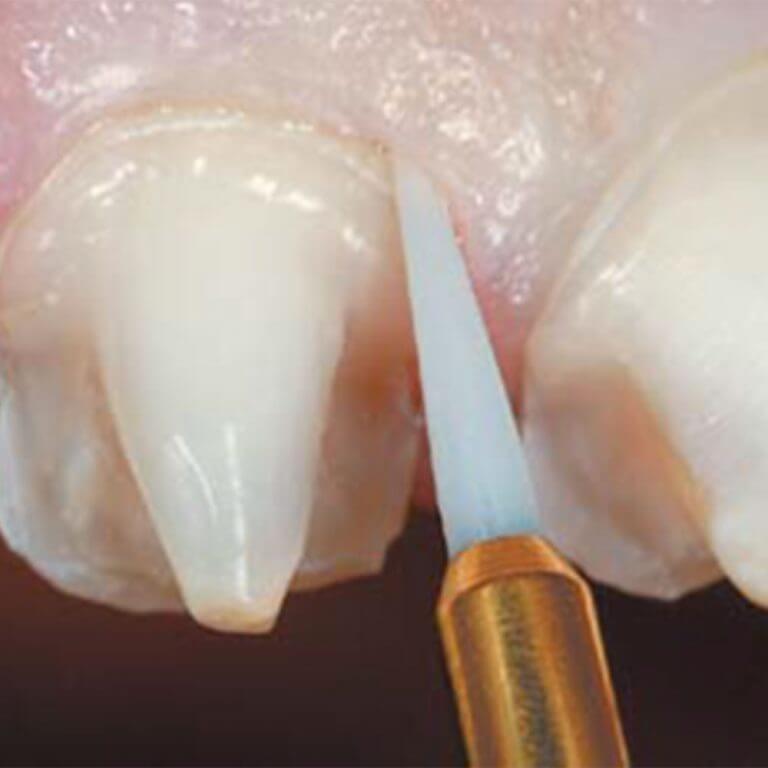 NTI Tissue Trimmer | Prestige Dental