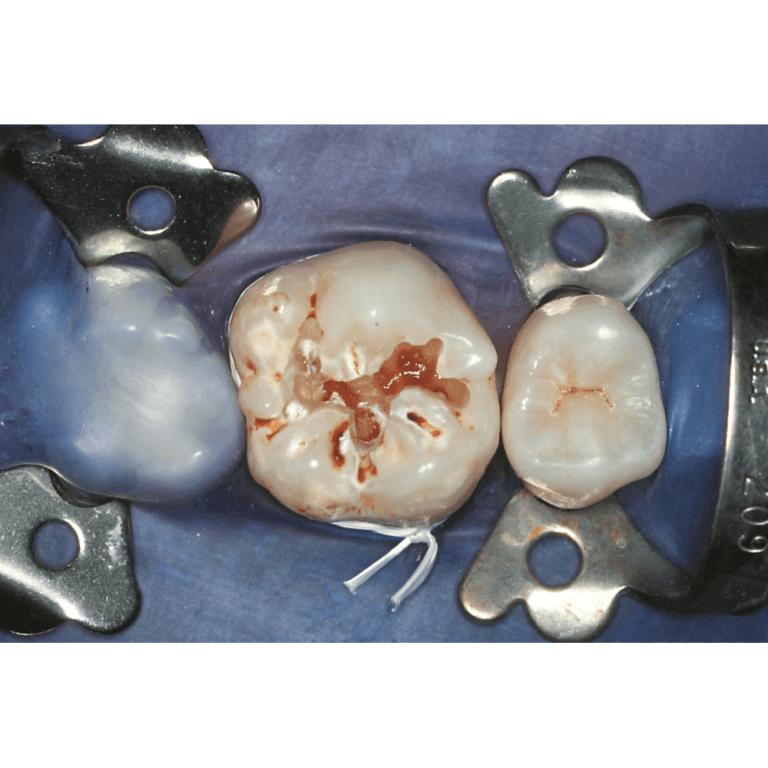 Snoop - Caries Detecting Dye | Prestige Dental