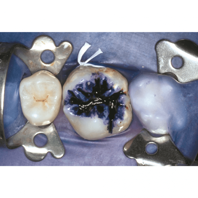 Snoop - Caries Detecting Dye | Prestige Dental