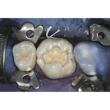 Snoop - Caries Detecting Dye | Prestige Dental