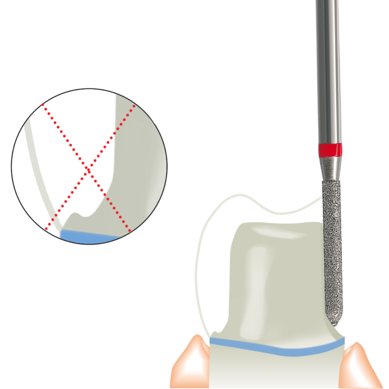 NTI Easy Chamfer Diamond Burs | Prestige Dental